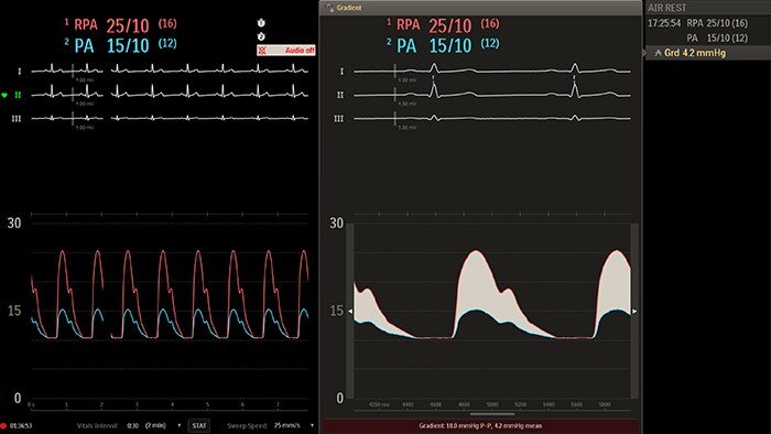 Congenital Heart Disease Interventions | Philips