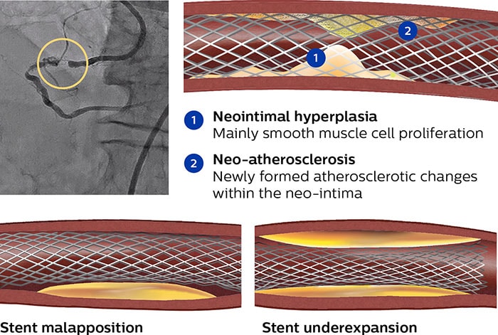 In-stent restenosis | Philips