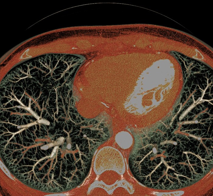 Photon Counting L Philips Healthcare