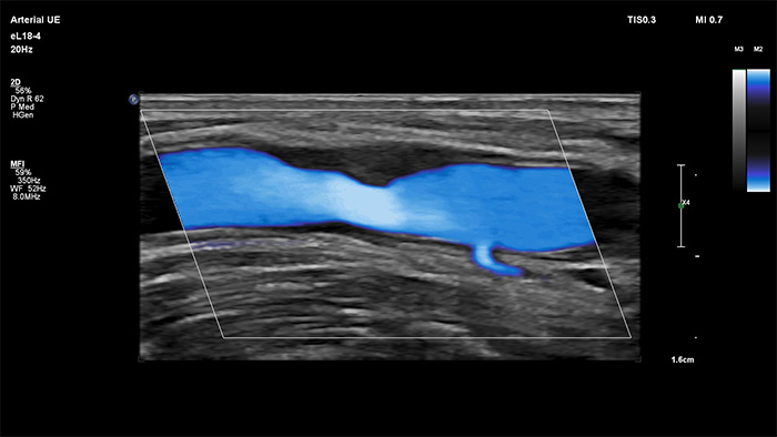 Vascular Ultrasound Machine Portfolio | Philips Healthcare