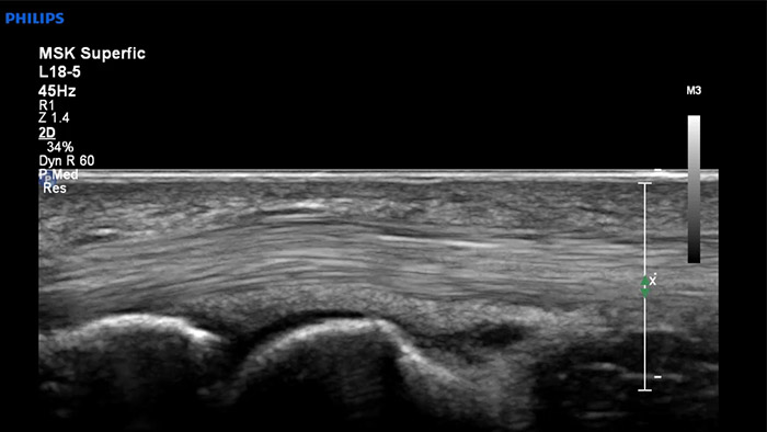 Musculoskeletal Ultrasound Resources | Philips