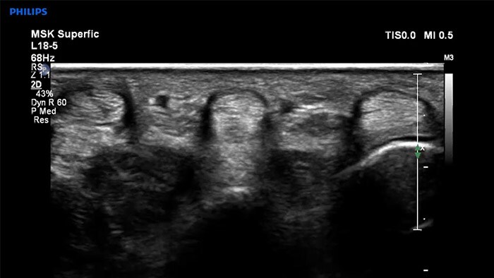 Musculoskeletal Ultrasound Resources | Philips Healthcare